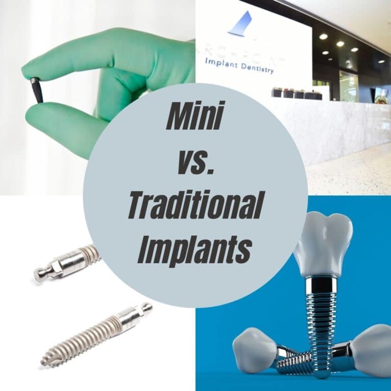 What are Mini Dental Implants?